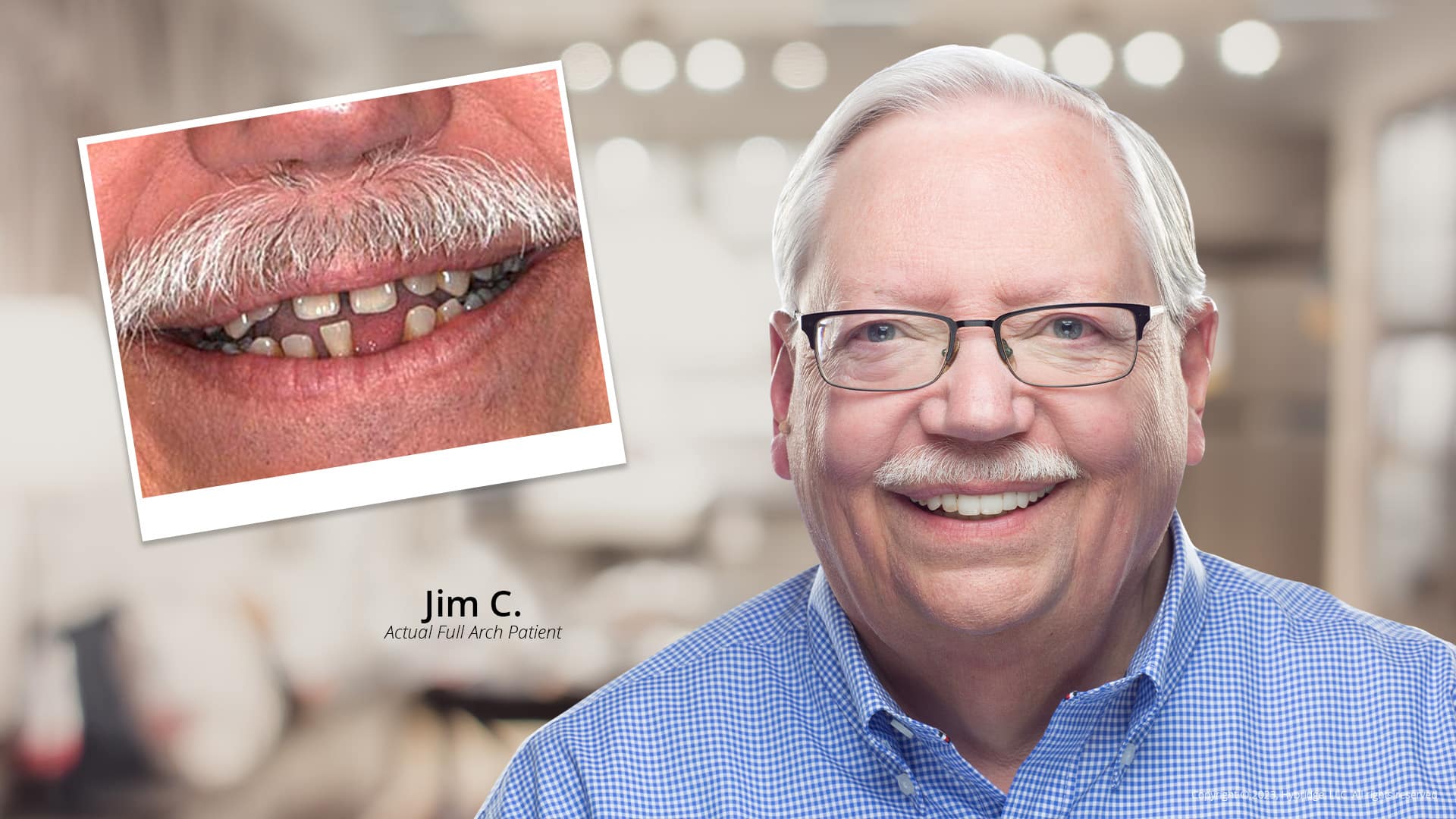 Dental Implants Vacaville, CA — Blue Ridge Family Dental